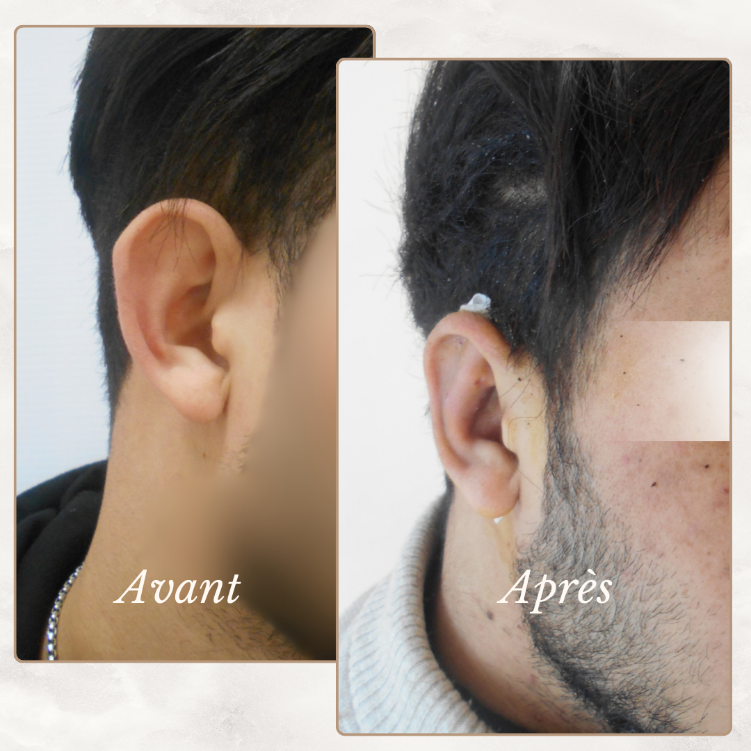 Otoplastie Au Maroc - Dr Berrada Khalid - Chirurgien esthétique et ...