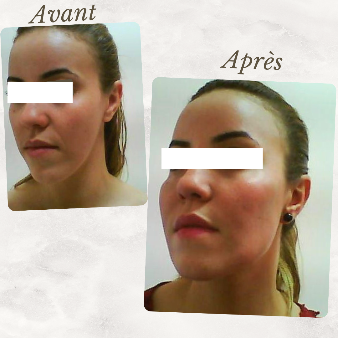 LES PHOTOS AVANT APRES CHIRURGIE ESTHÉTIQUE - Dr Berrada Khalid ...