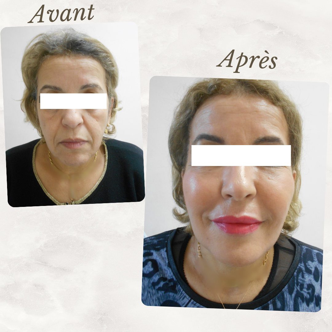 LES PHOTOS AVANT APRES CHIRURGIE ESTHÉTIQUE - Dr Berrada Khalid ...